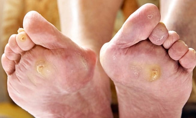 Foot Ulcer Treatment for Various Foot Ulcers | BioFlex Pakistan