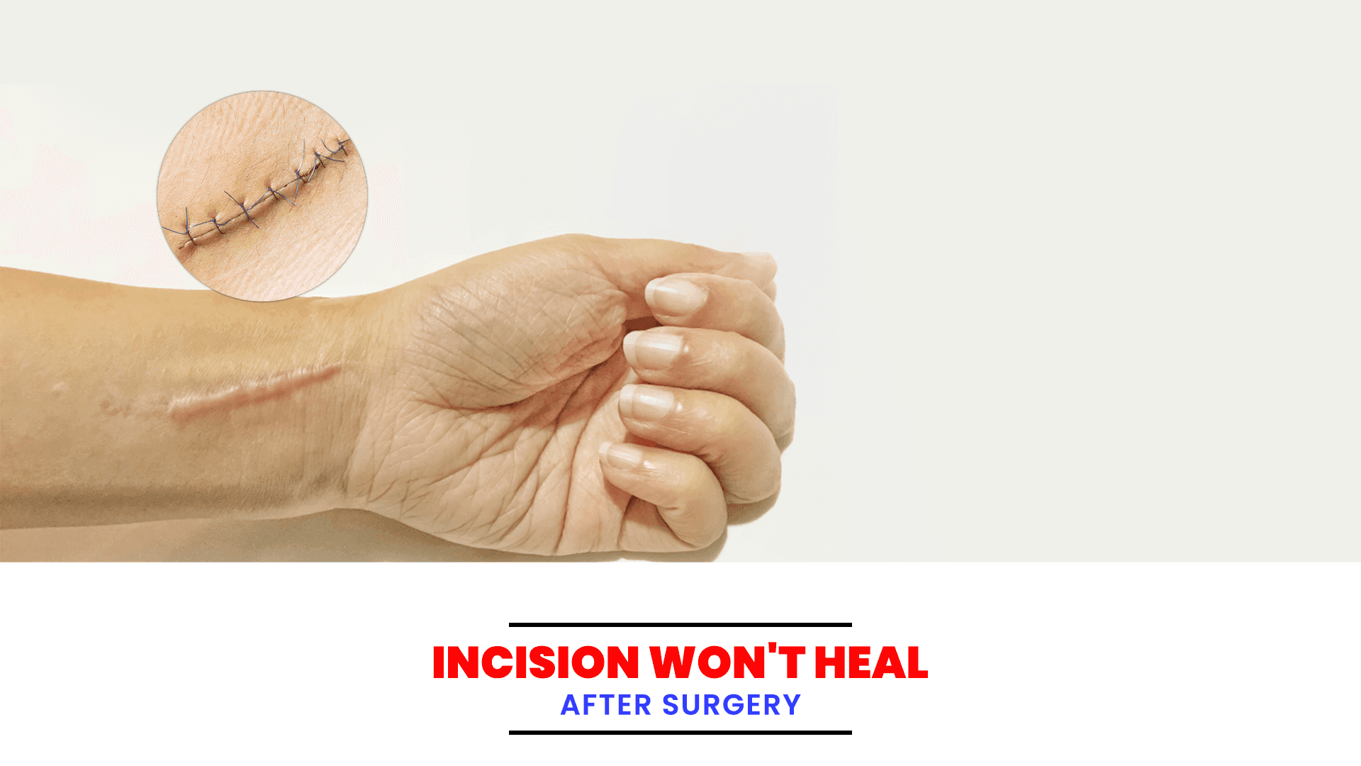 Incision Won't Heal After Surgery | BioFlex Pakistan