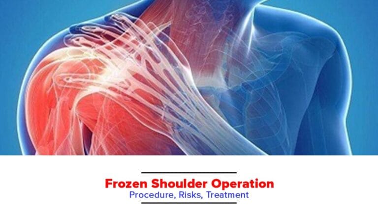 Frozen Shoulder Operation: Procedure, Risks, Treatment | BioFlex Pakistan