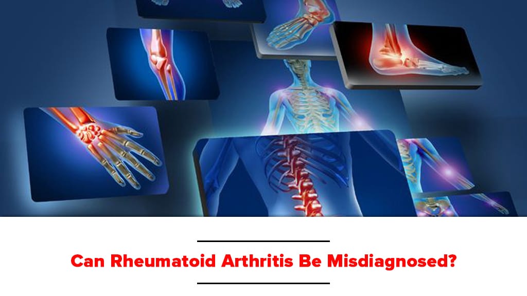 Can Rheumatoid Arthritis Be Misdiagnosed? | BioFlex Pakistan